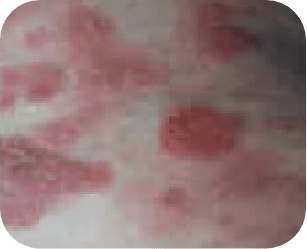 What is cutaneous T-cell lymphoma (CTCL)? | POTELIGEO® (mogamulizumab-kpkc)