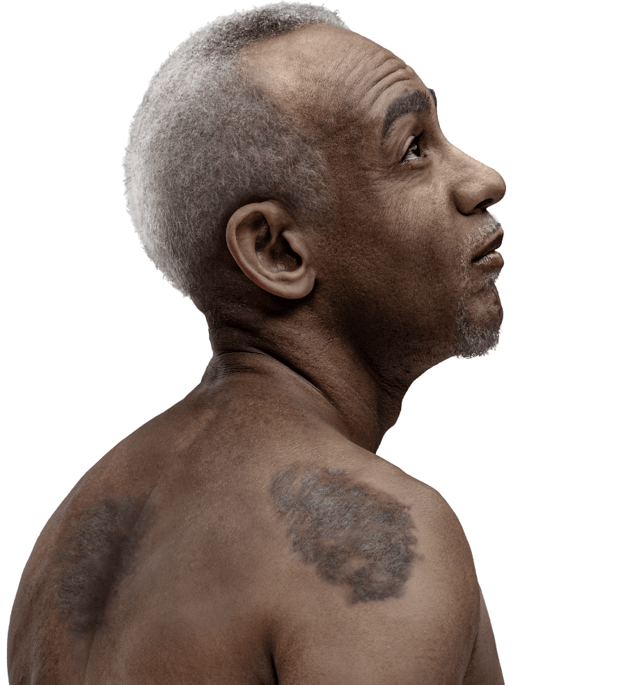 Non-Chemo Treatment Option | POTELIGEO® (mogamulizumab-kpkc)